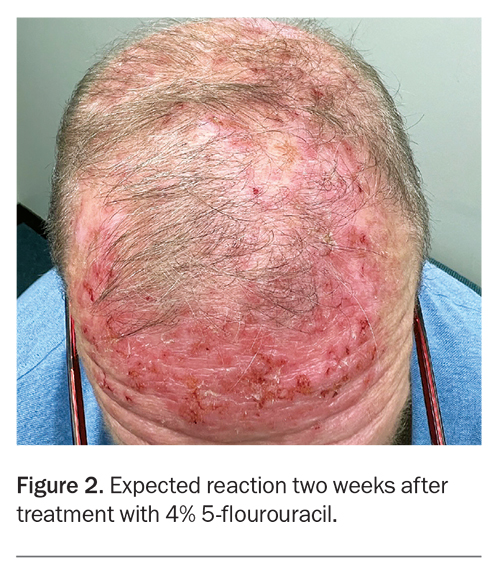 Actinic Keratosis An Update On Management Medicine Today
